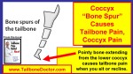 Reasons Why Doctors can NOT just “Shave Down” a Coccyx Bone Spur ...