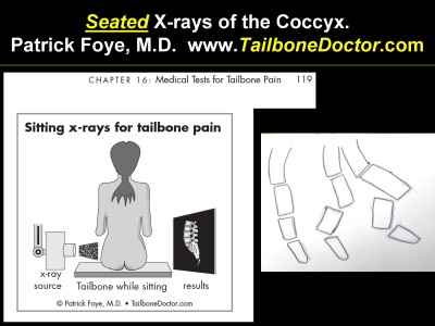 SEATED Coccyx X-rays Show Abnormalities Missed by Regular Standing X ...