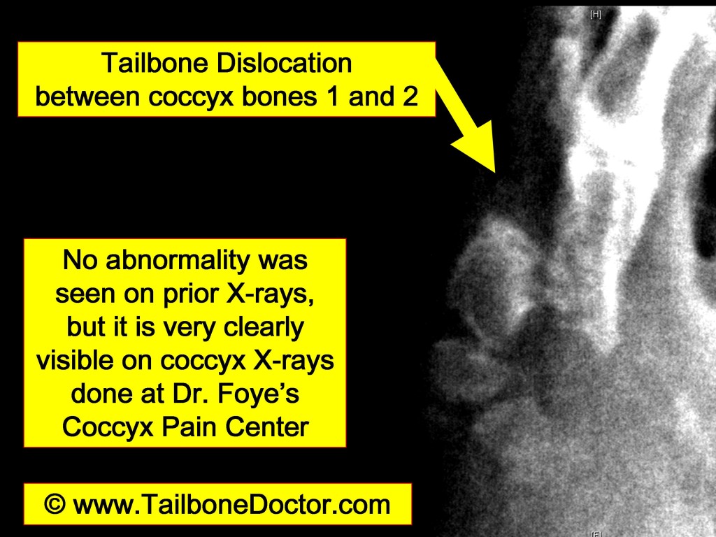 Tailbone Images (for coccyx pain) | Tailbone Doctor