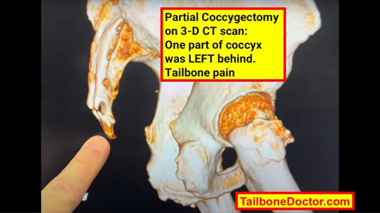 BLOG on Tailbone Pain (Coccyx Pain) | Tailbone Doctor
